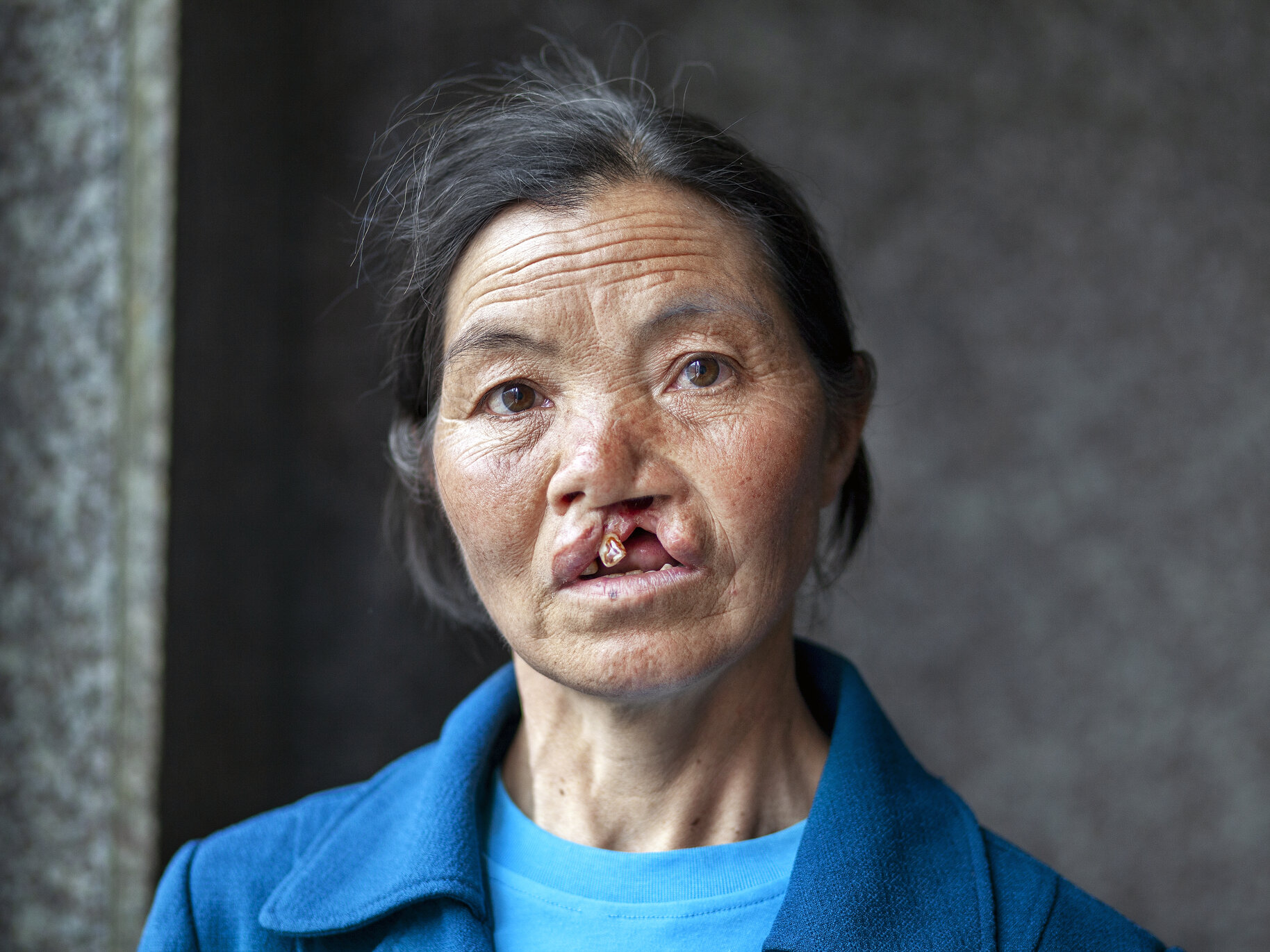 China | Operation Smile
