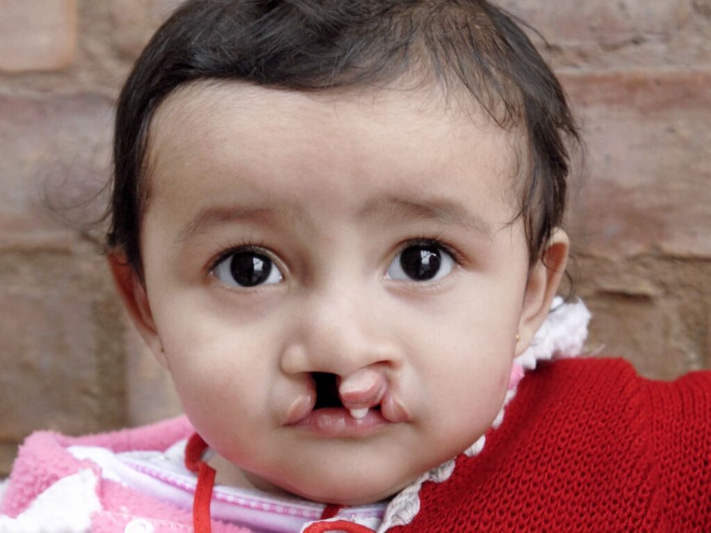 What is Cleft Lip and Palate? Key Facts You Should Know | Operation Smile