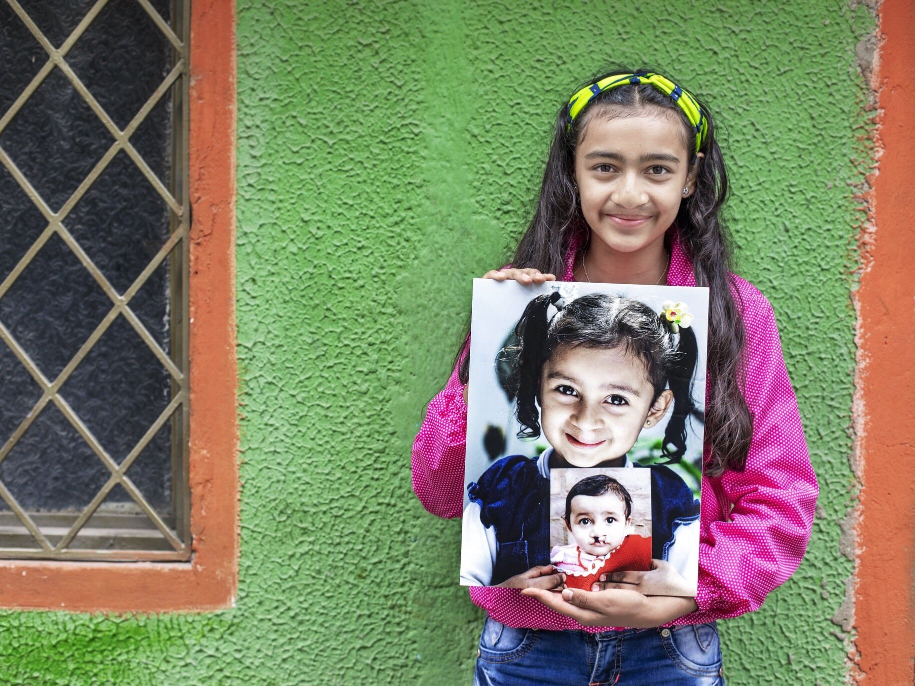 What is Cleft Lip and Palate? Key Facts You Should Know | Operation Smile