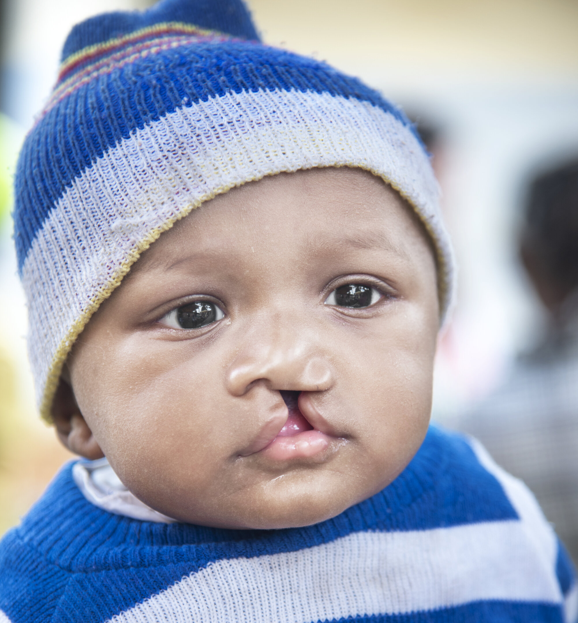 The Impact of One, Changes the Lives of Many | Operation Smile