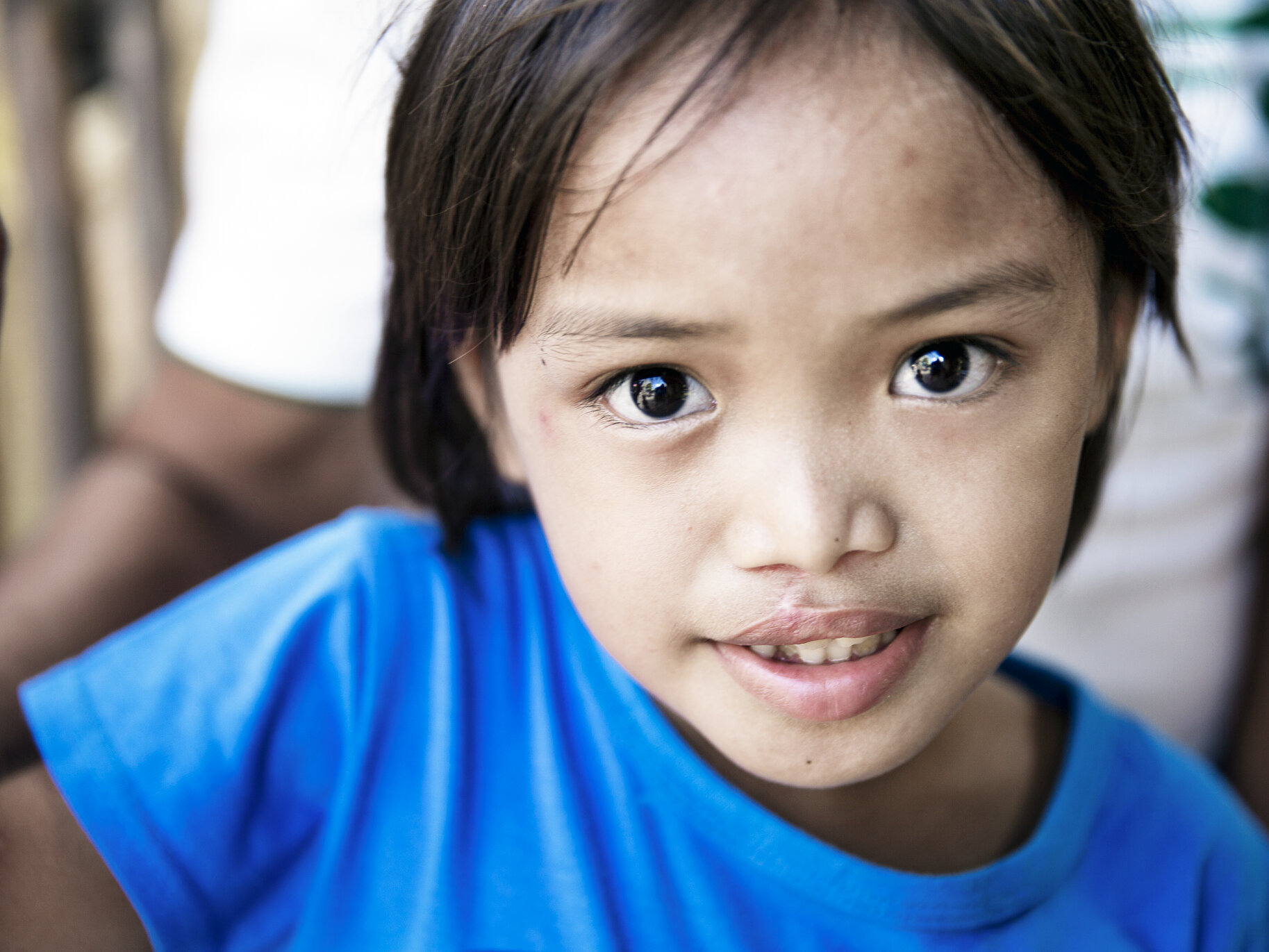 Philippines | Operation Smile